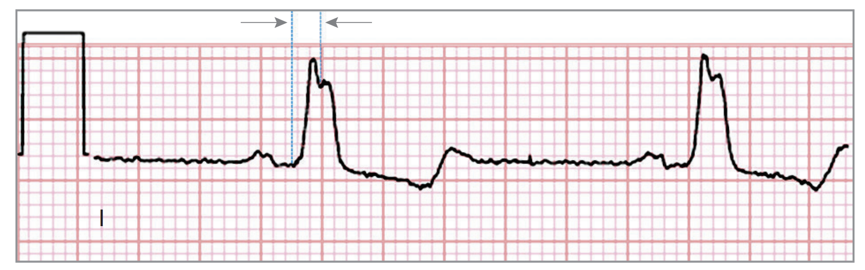 A Fresh Perspective on Identifying Left Bundle Branch Block - Medical ...